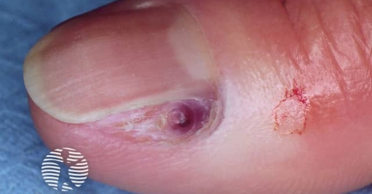 Melanoma of nail unit image