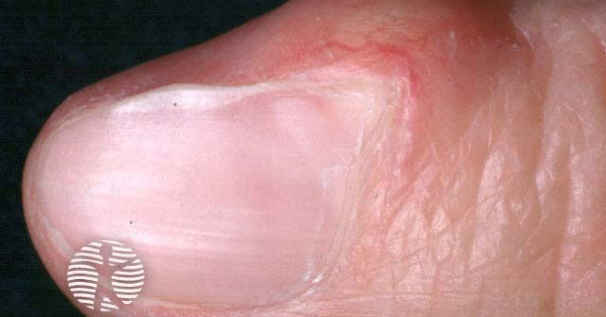 Inclusion epidermal cyst image