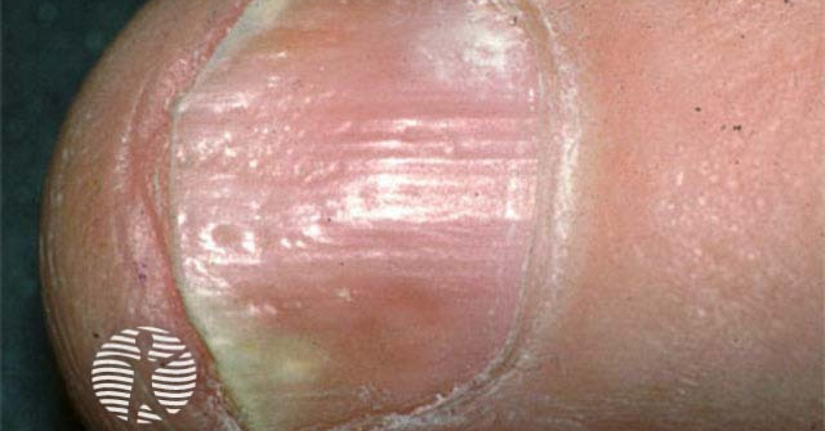 Nail psoriasis image
