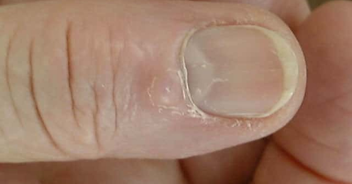 Pseudomyxoid cyst of nail image