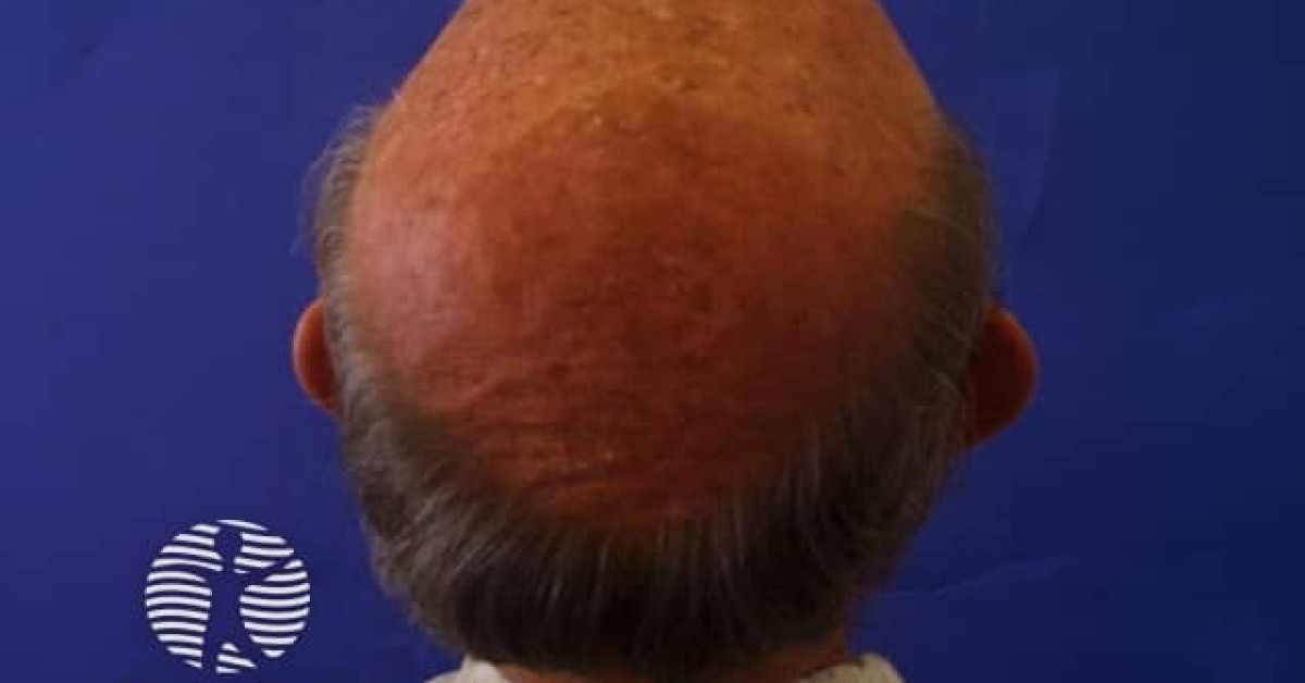 Pattern Balding Image