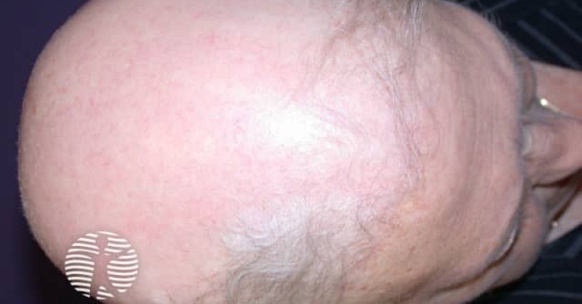 Alopecia areata image