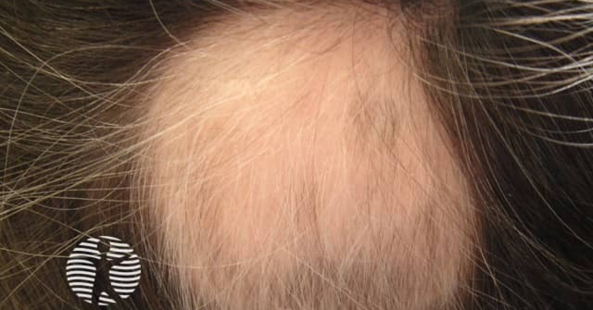 Alopecia areata image