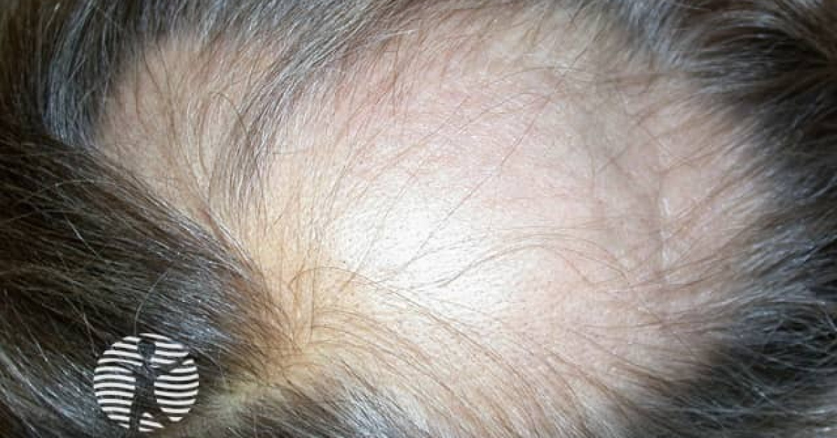 Alopecia areata image