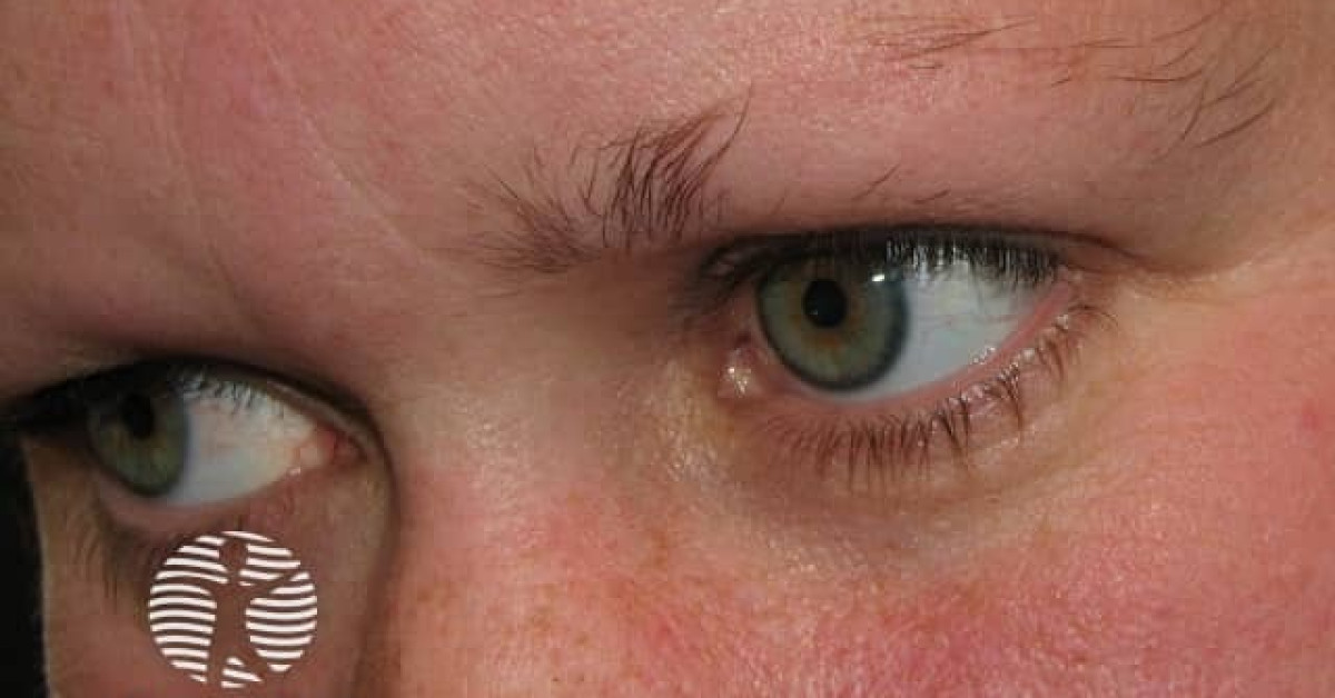 Anagen effluvium: loss of eyebrows in alopecia areata image