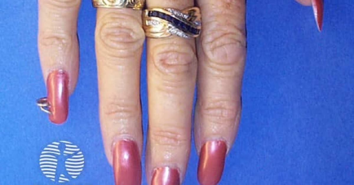 DermNet® - Acrylic nail image