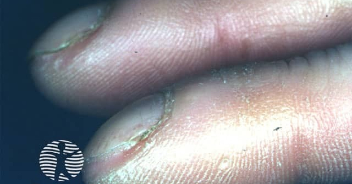 Clubbing of nail image