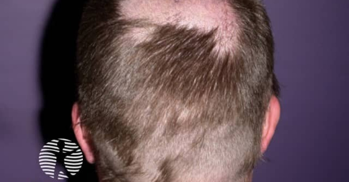 Alopecia From Drugs Image