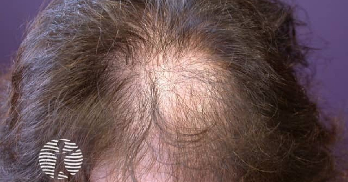 DermNet® - Female balding image