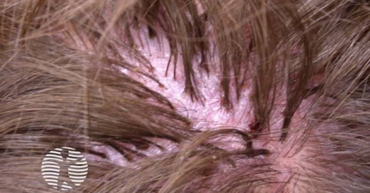 Folliculitis Decalvans Image