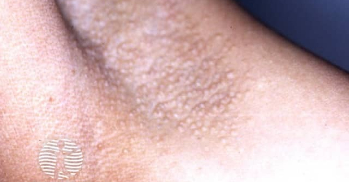 Fox-Fordyce disease image