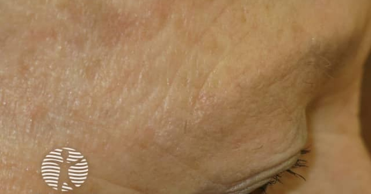 Graham Little syndrome. Loss of hair of eyebrows image