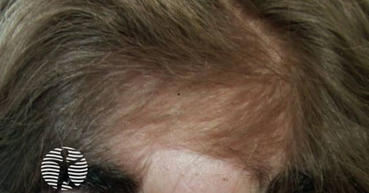 Hypertrichosis image