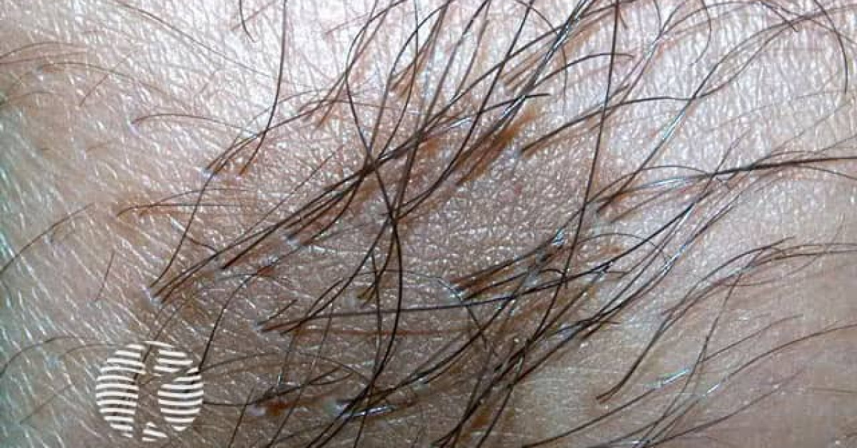 Hypertrichosis image