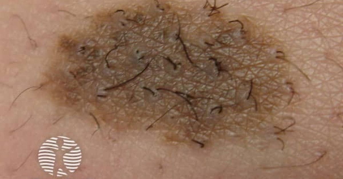 Congenital naevus image