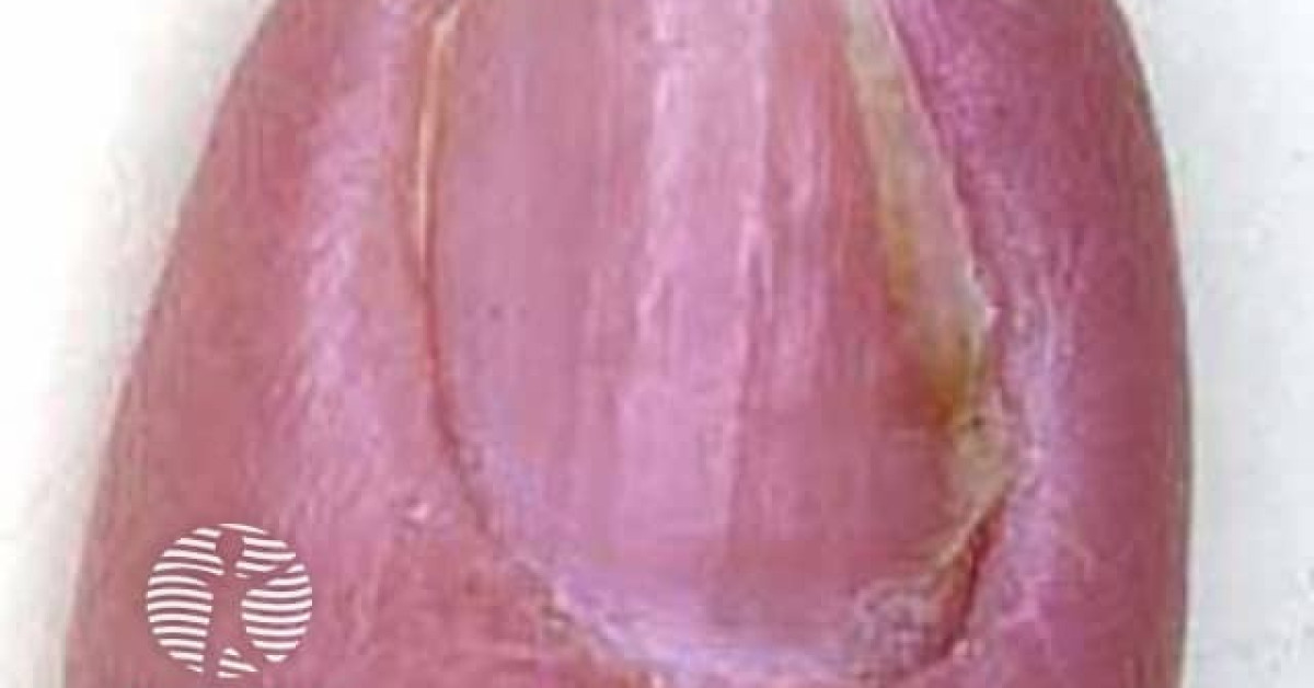 Nail candidiasis image