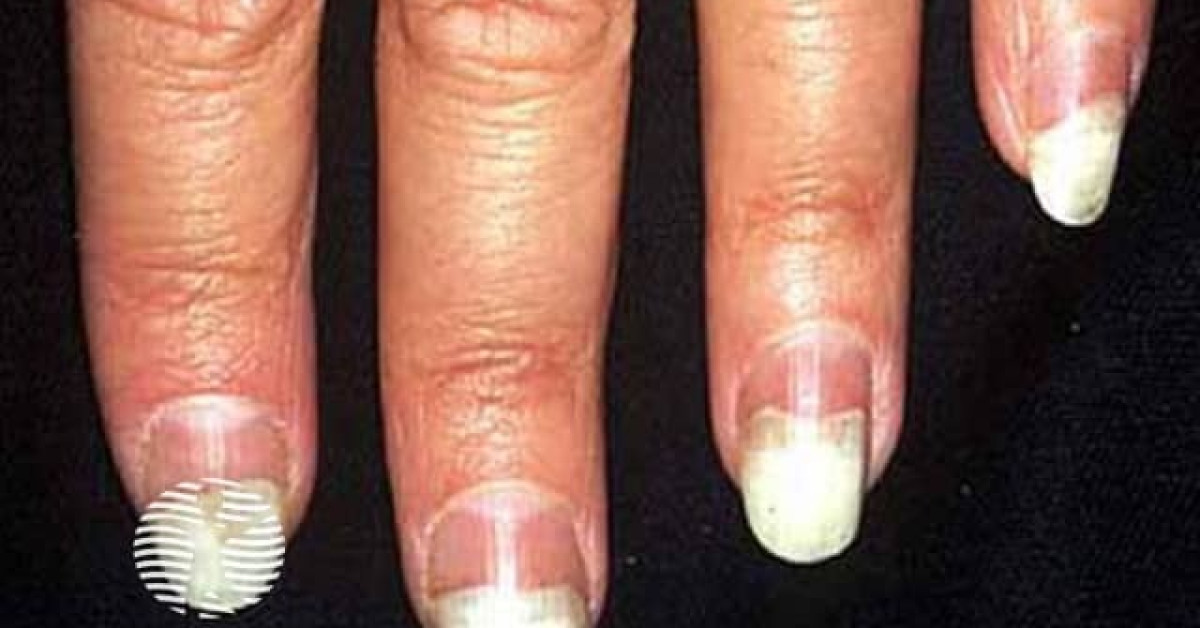 Photo-onycholysis image