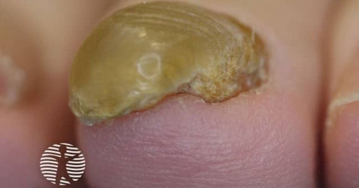 Onychogryphosis Ramshorn Onychogryphosis Meyering Method