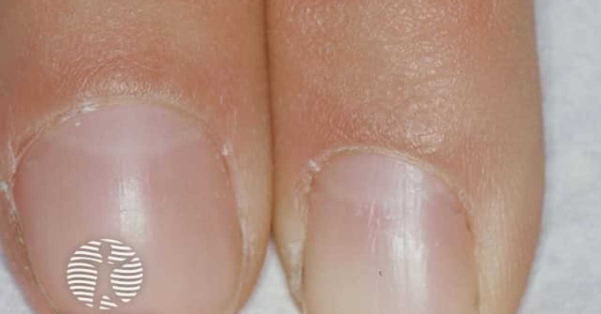 Nail enlargement due to osteoma image