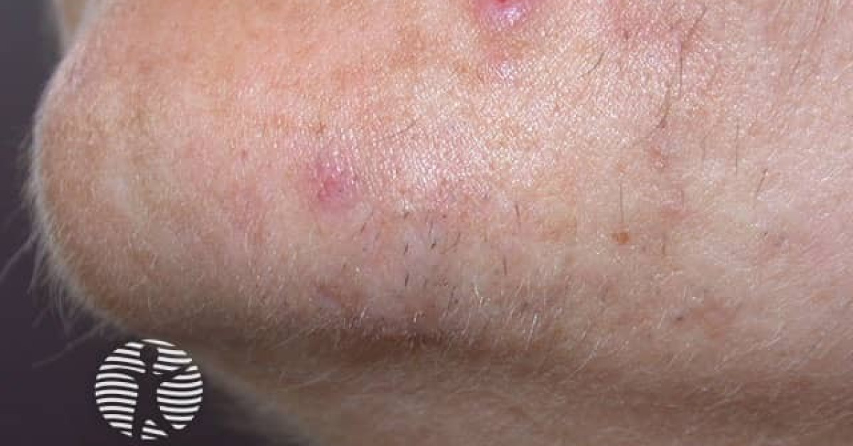 Folliculitis due to hair removal image