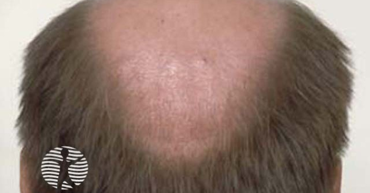 Pattern balding image