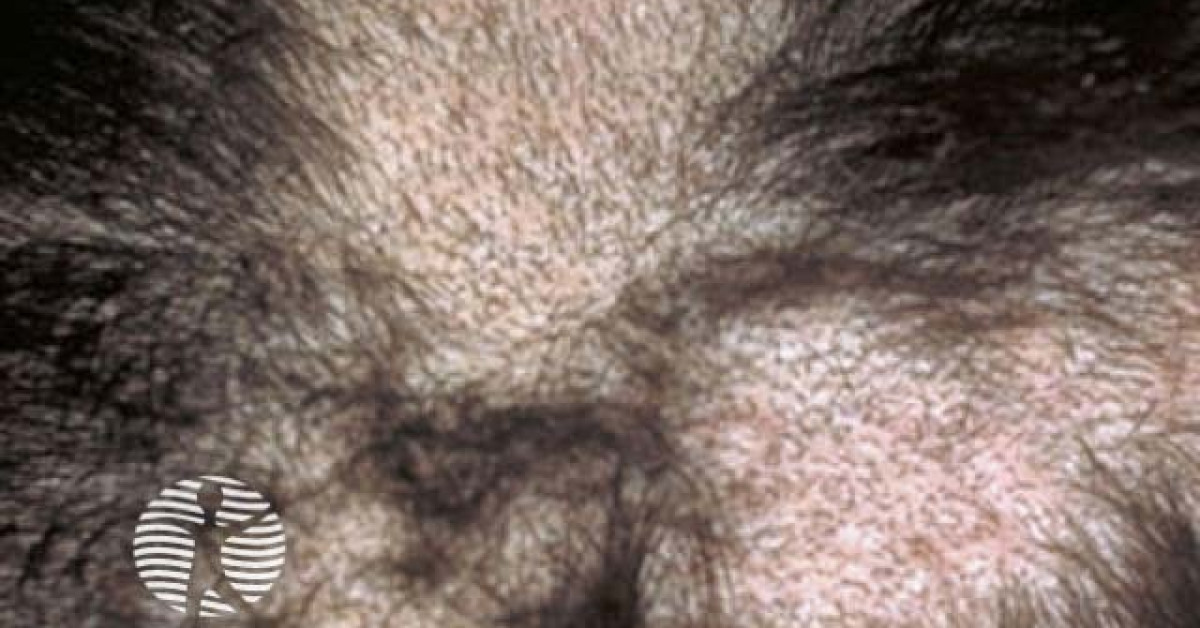 DermNet® - Trichotillomania image