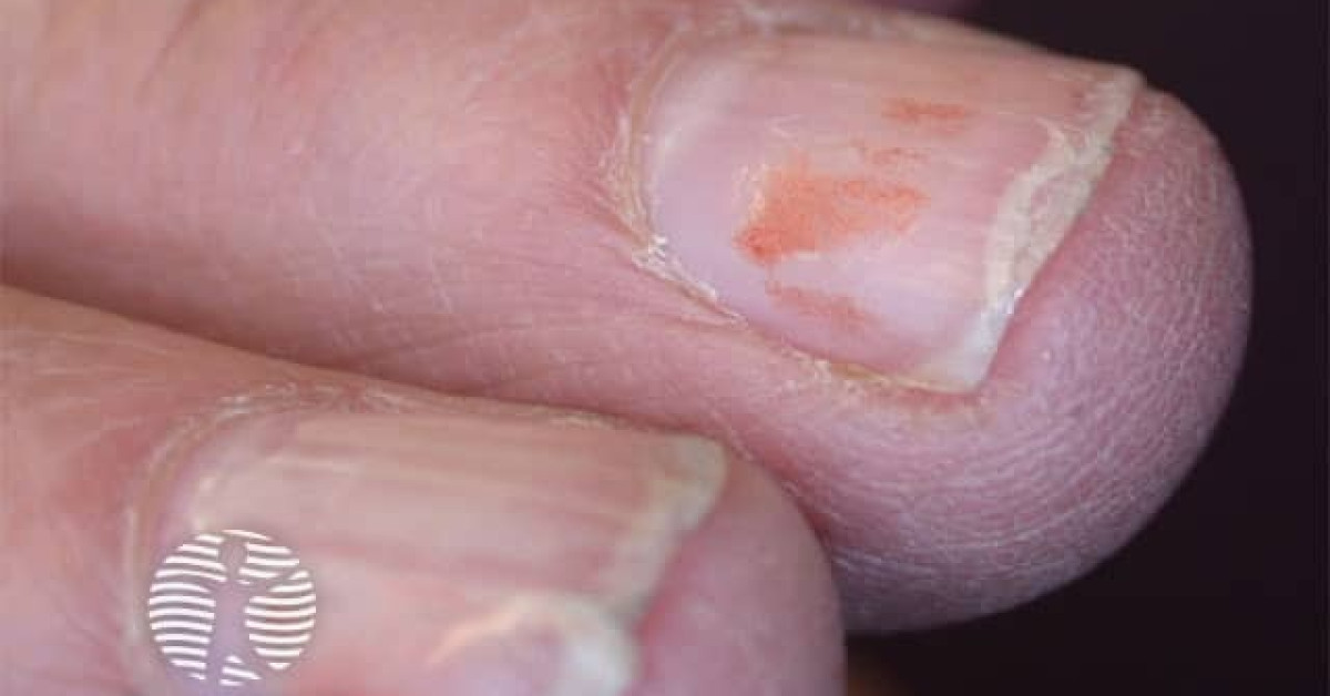 Nail splitting: onychoschizia image
