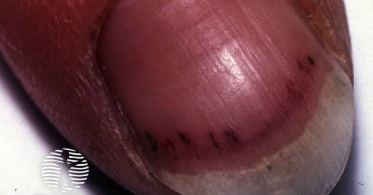Splinter haemorrhages image