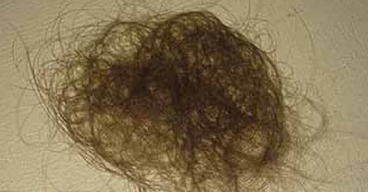 Telogen effluvium image