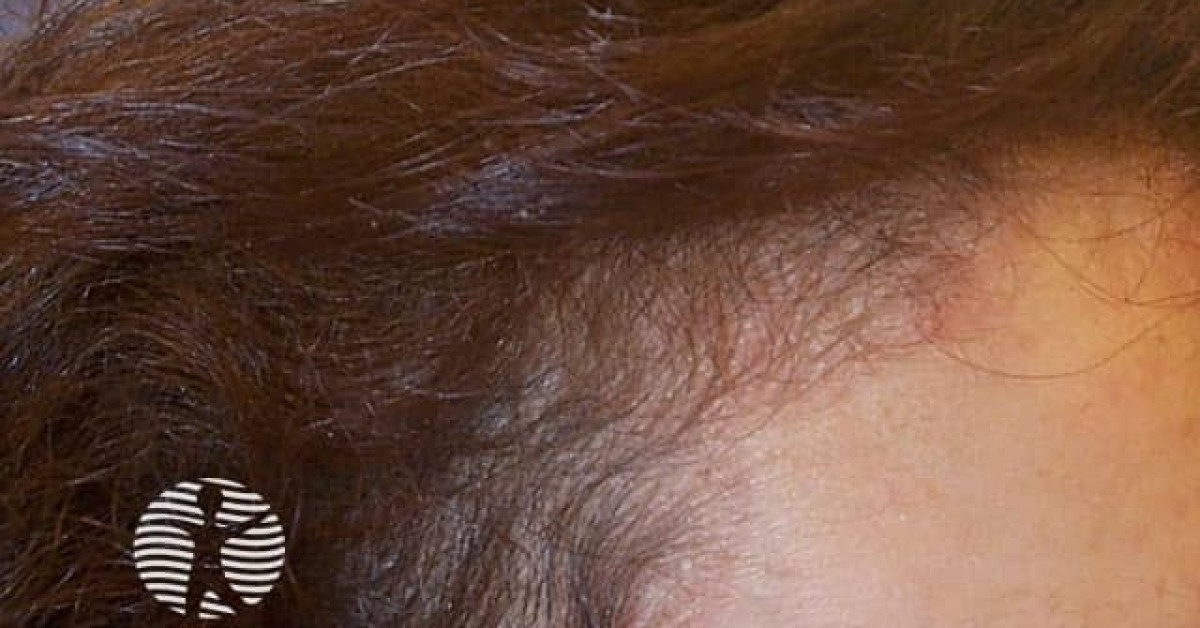 Telogen effluvium image