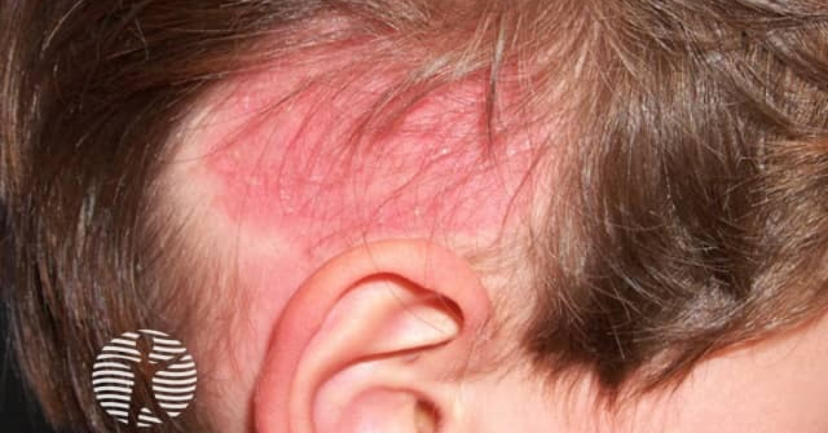 Tinea capitis image