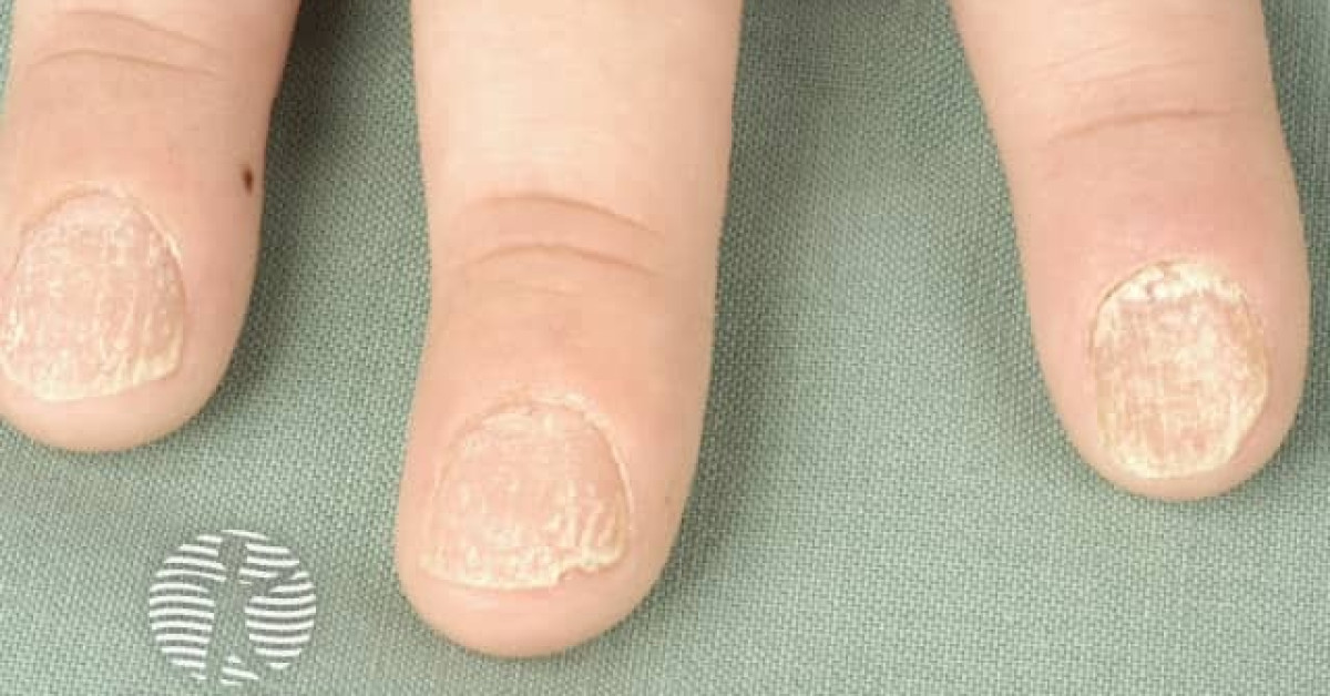 Trachyonychia image