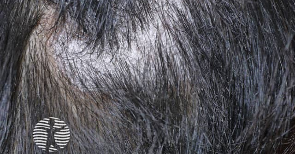 Broken-off hair with trichorrhexis nodosa image
