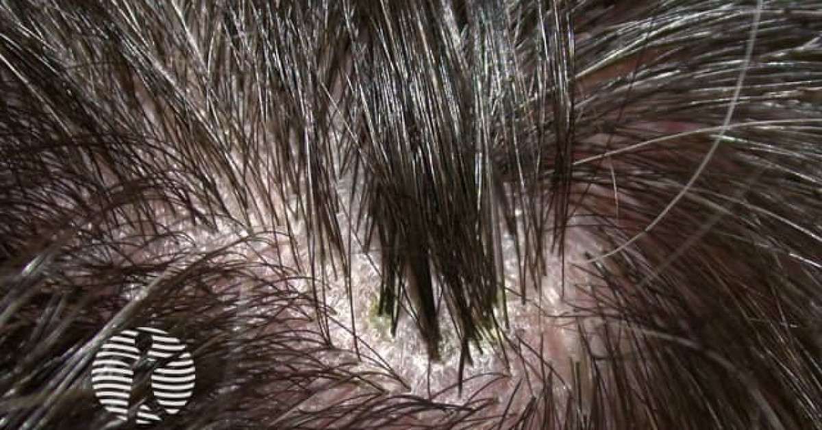 Tufted folliculitis image