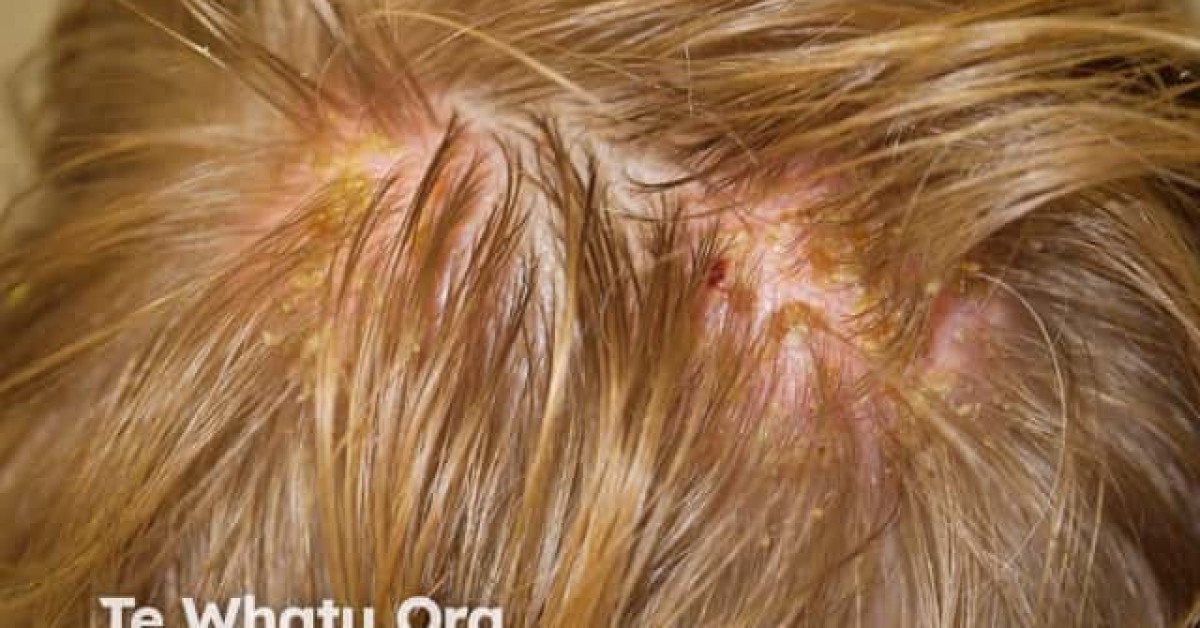 Anagen effluvium: fungal infection (kerion) image