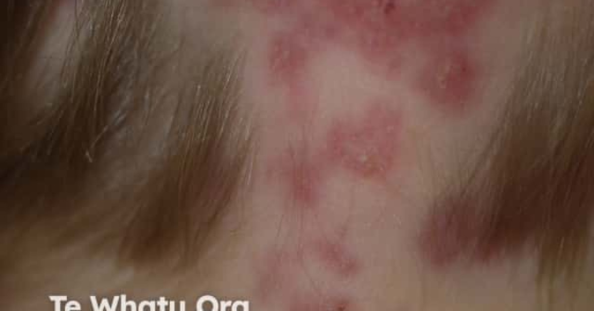 Anagen effluvium: fungal infection (kerion) image