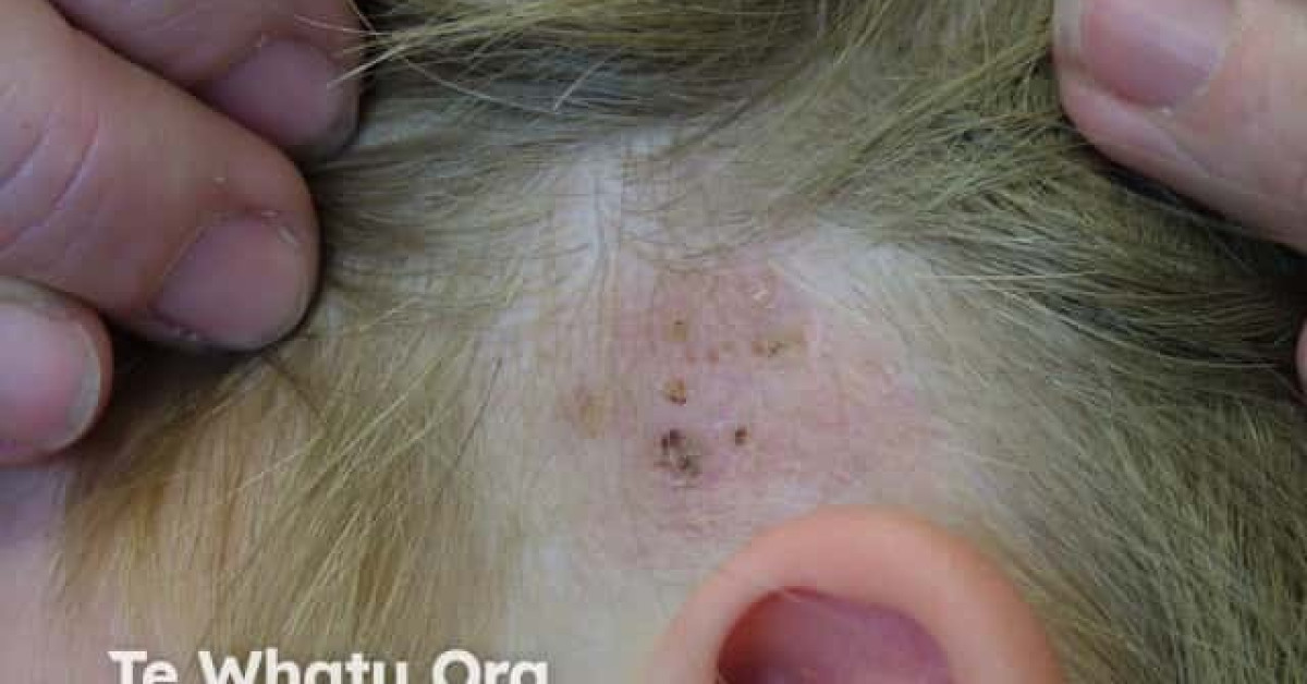 Anagen effluvium: fungal infection (kerion) image