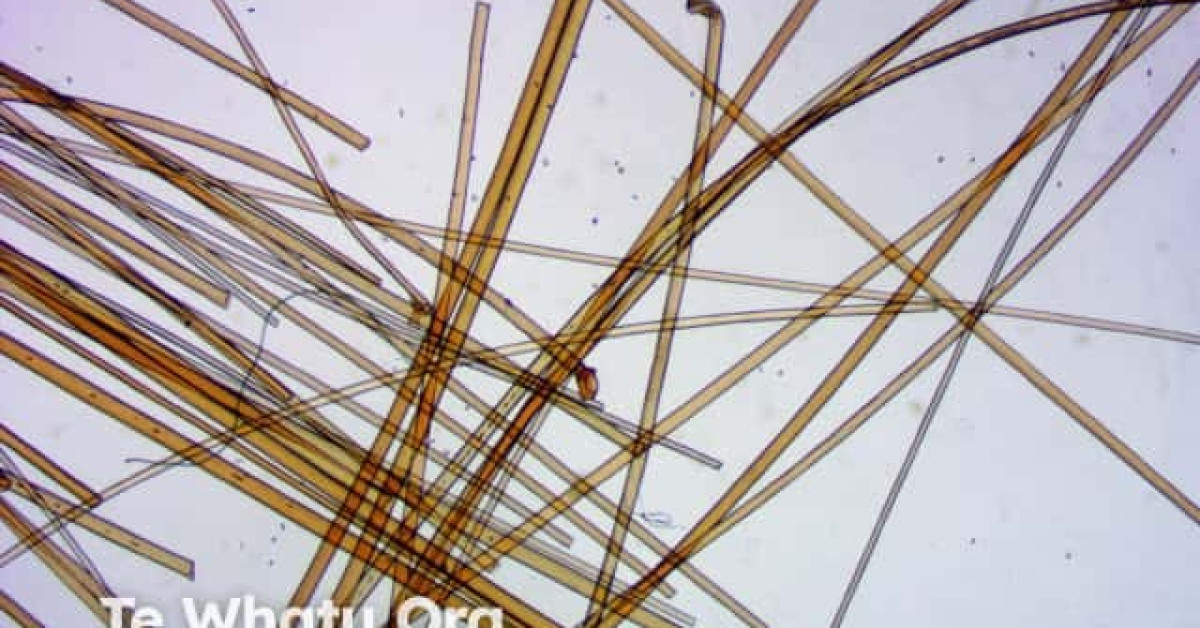 Loose anagen hair syndrome image