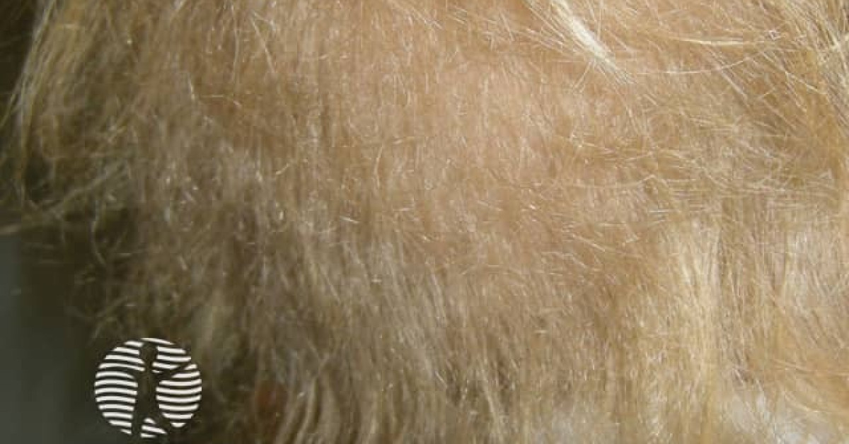 Woolly hair naevus image