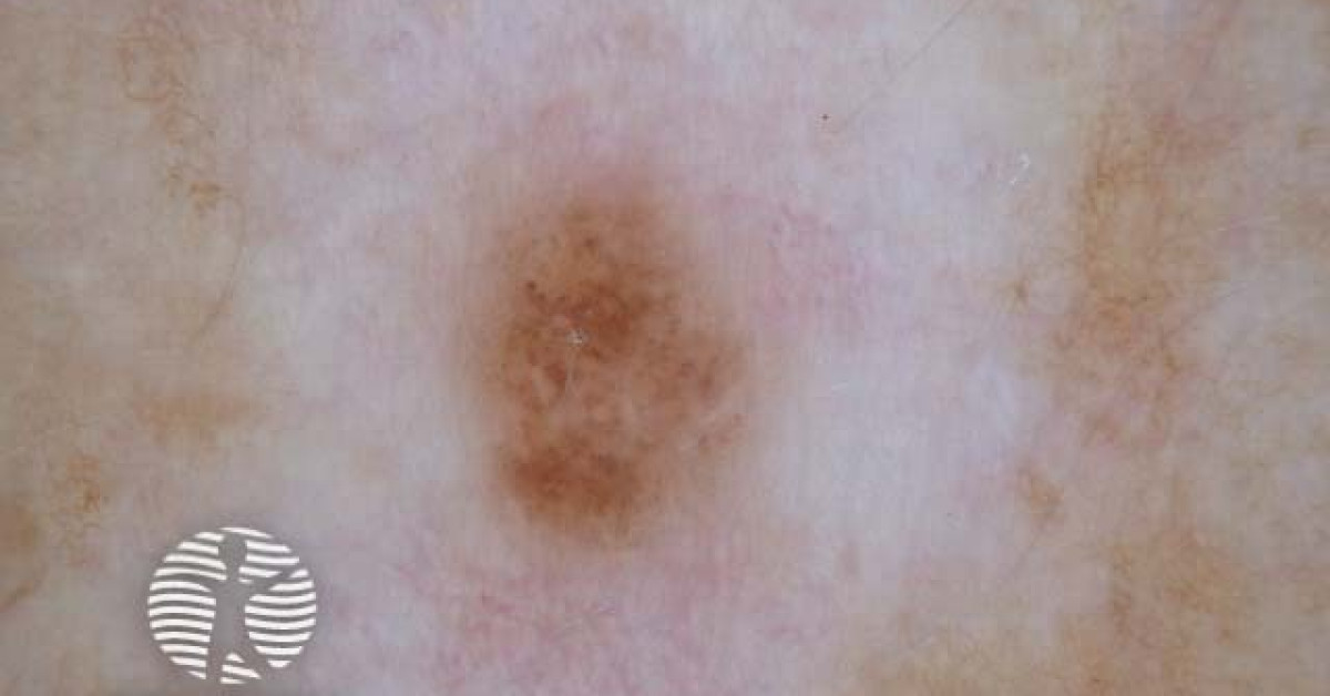 Halo naevus dermoscopy image