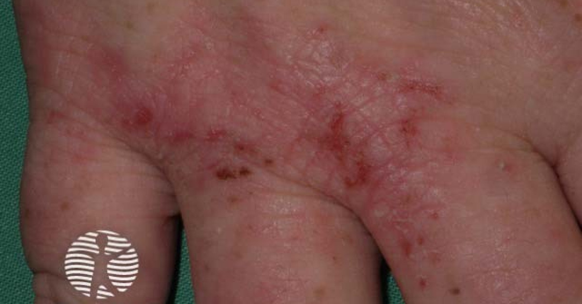 DermNet® - hand dermatitis in patient on antiTNF image