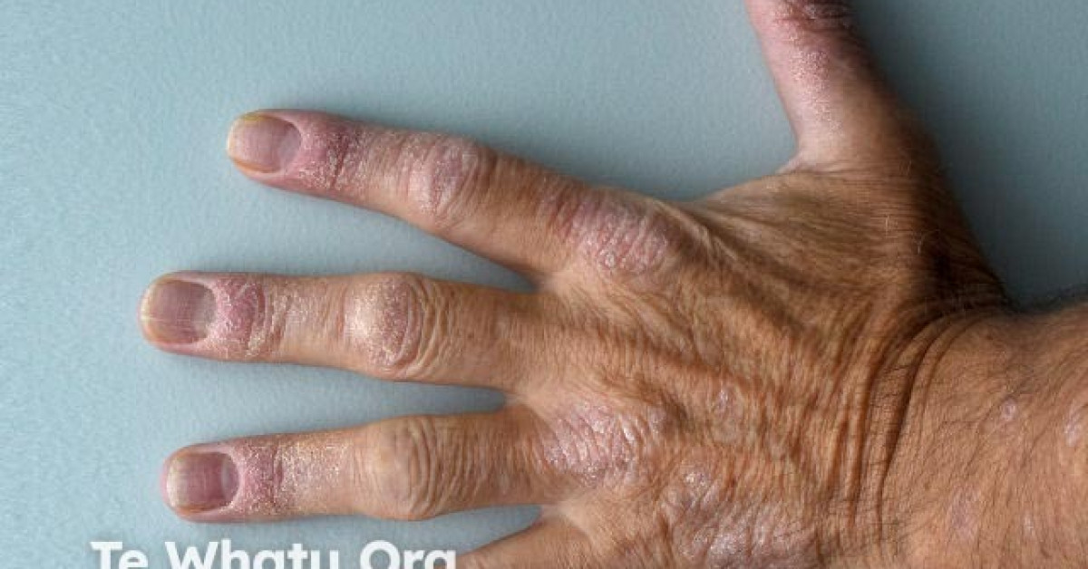 Psoriasis on the dorsal hand image