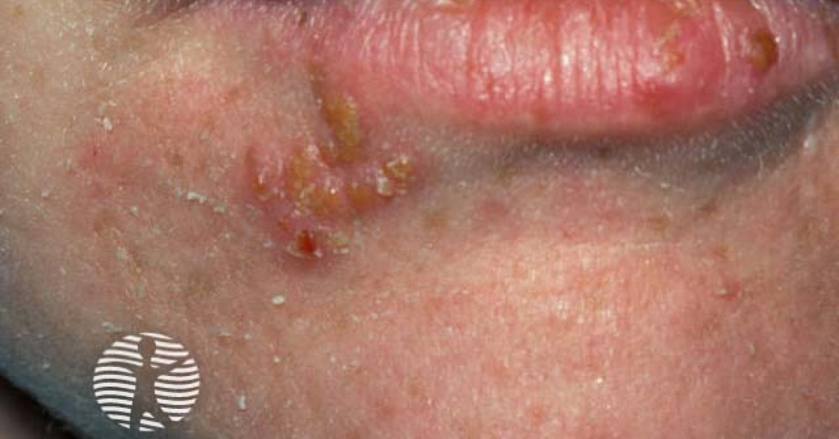 Acd Az Of Skin Herpes Labialis RED RASHES ON THE SKIN? READ THIS