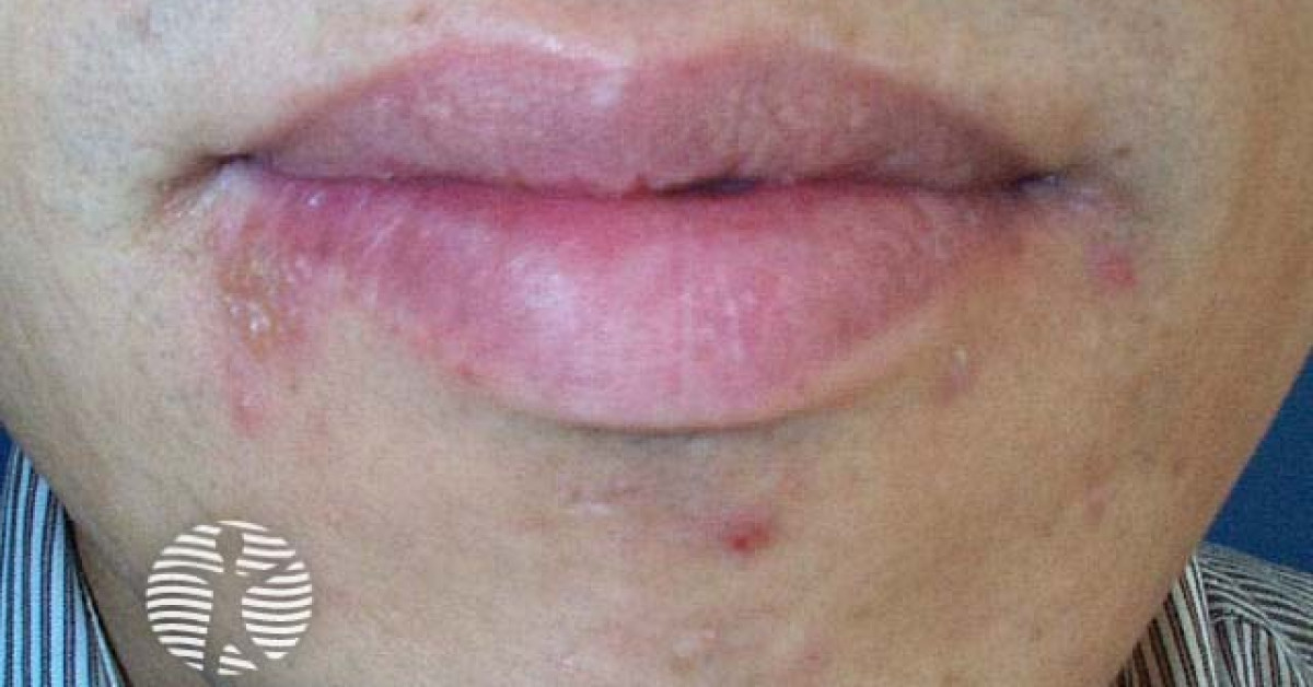 Herpes simplex labialis image