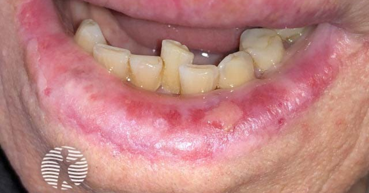 Herpes simplex labialis image