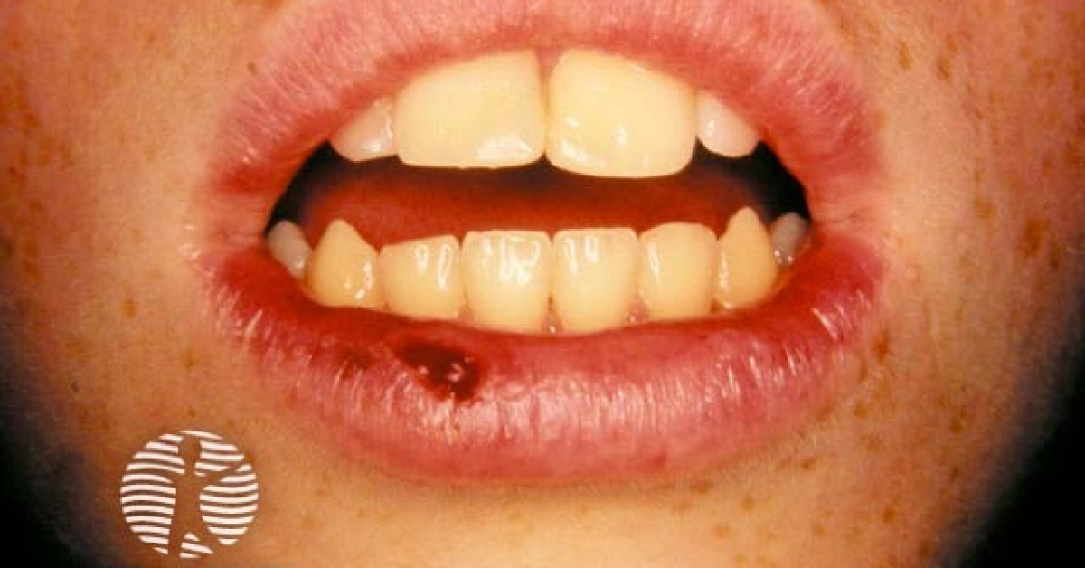 Herpes simplex labialis image