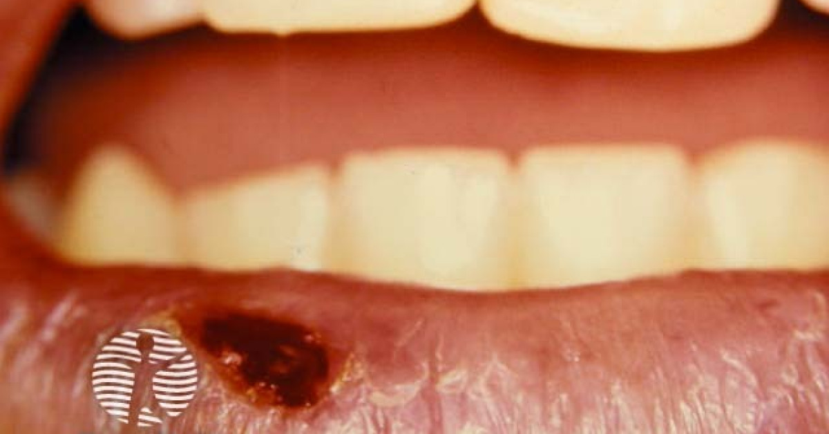 Herpes simplex labialis image