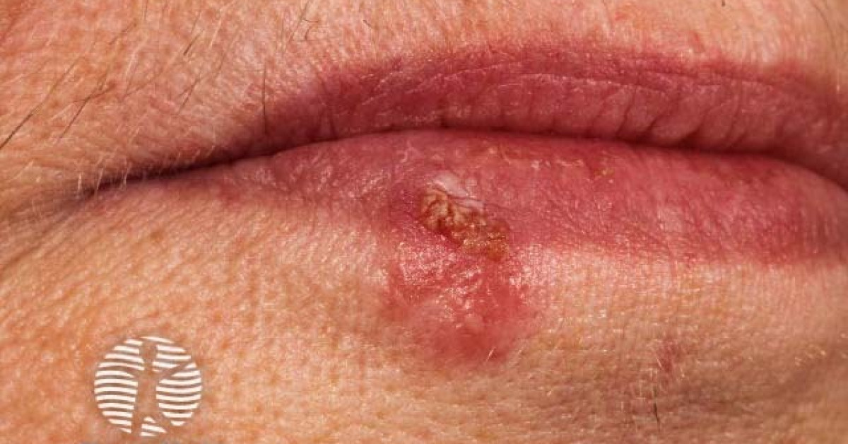 Herpes simplex labialis image