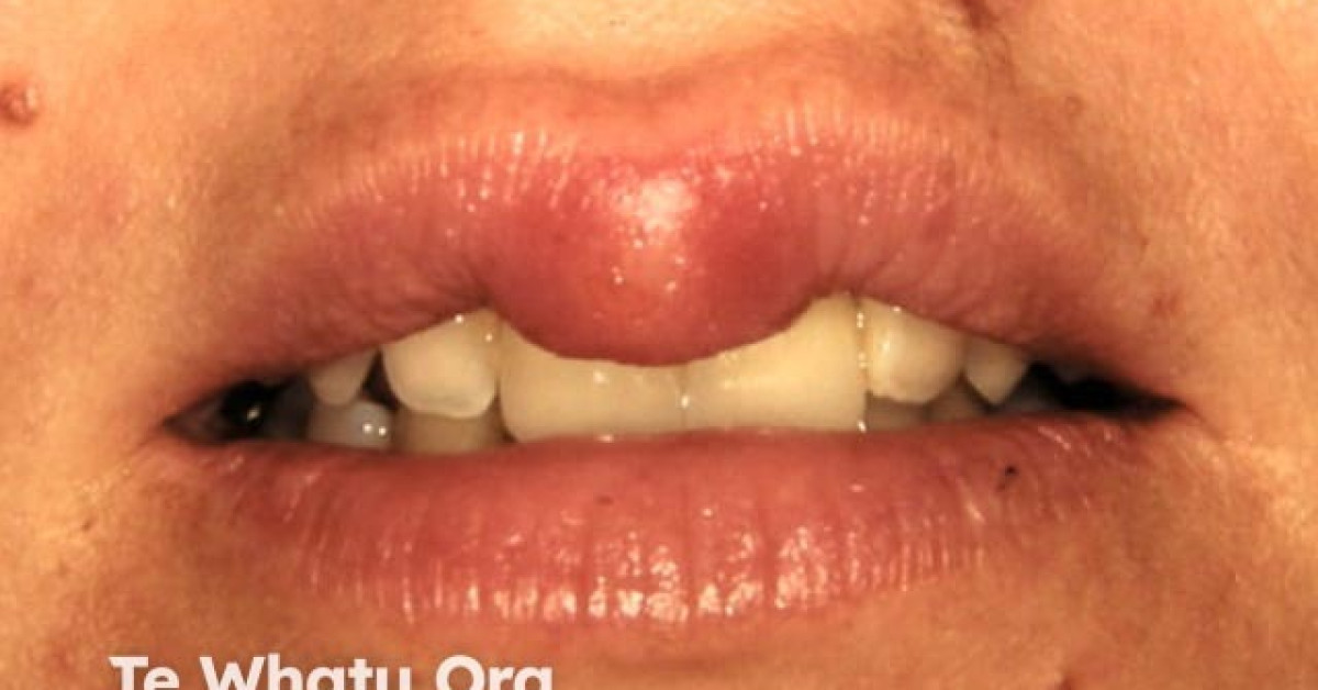 Herpes simplex labialis image