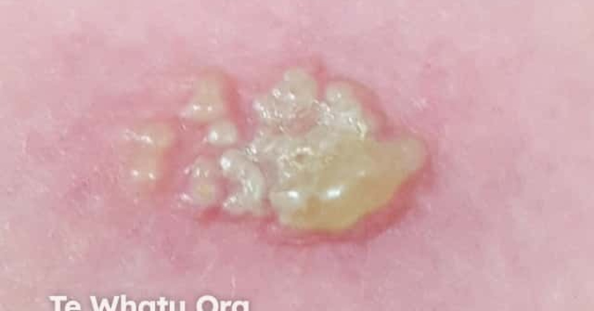 Herpes simplex 2 vesicles 1 image